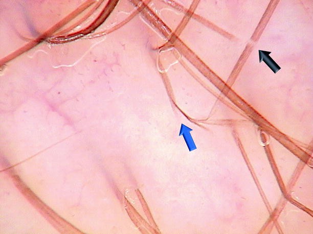 Trichorrhexis Nodosa | SpringerLink