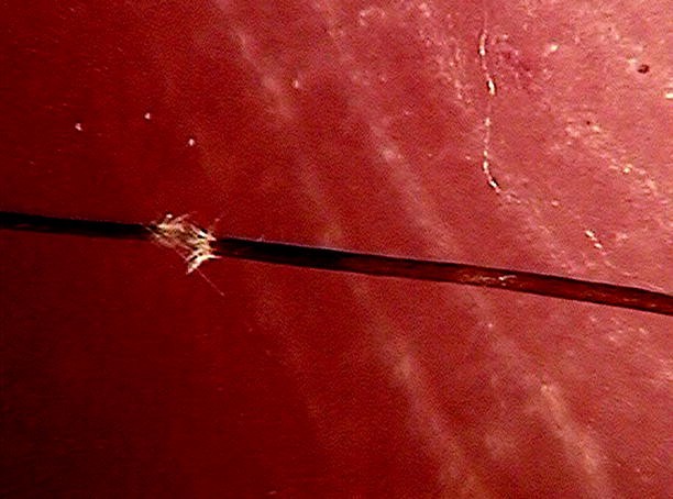 Trichorrhexis Nodosa | SpringerLink