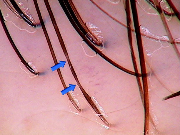 Hair Shafts | SpringerLink