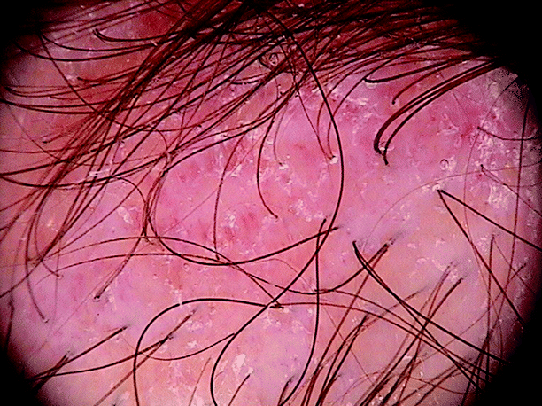 Discoid Lupus Erythematosus | SpringerLink