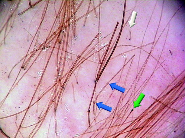Trichorrhexis Invaginata and Netherton’s Syndrome | SpringerLink