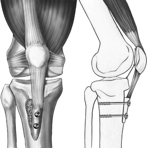Patella Infera and Patella Alta | SpringerLink