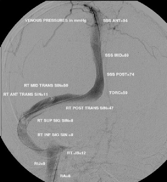 Cerebral Venography/Venous Pressure Monitoring/Venous Stenting ...