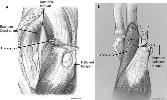 Tendon Injuries | SpringerLink