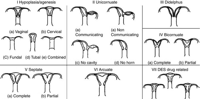 Uterine Anomalies | SpringerLink