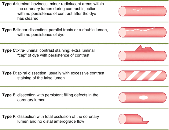 Coronary Dissection | SpringerLink