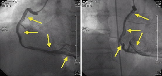 Coronary Dissection | SpringerLink