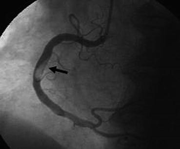 Coronary Dissection | SpringerLink