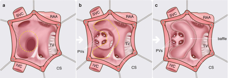 Atrial Baffles for the Treatment of Transposition of the Great Arteries ...