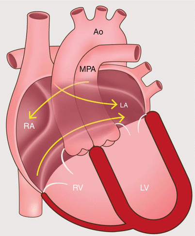 Atrial Baffles for the Treatment of Transposition of the Great Arteries ...