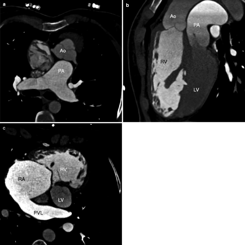 Atrial Baffles for the Treatment of Transposition of the Great Arteries ...
