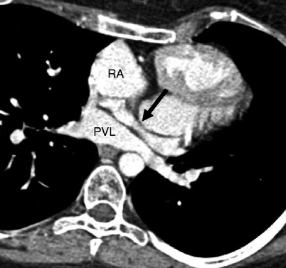 Atrial Baffles for the Treatment of Transposition of the Great Arteries ...