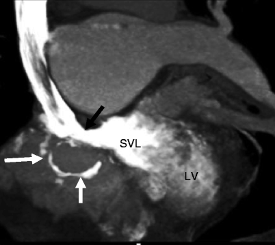 Atrial Baffles for the Treatment of Transposition of the Great Arteries ...