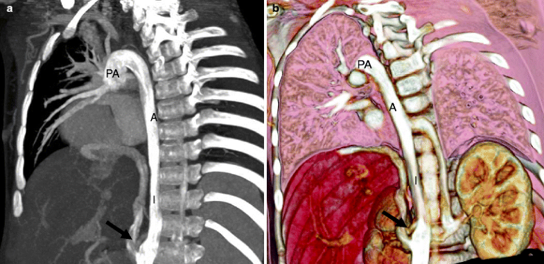 Systemic Vein to Pulmonary Artery Shunts: Glenn, Fontan, and Kawashima ...