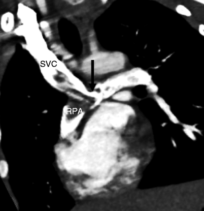 Systemic Vein to Pulmonary Artery Shunts: Glenn, Fontan, and Kawashima ...
