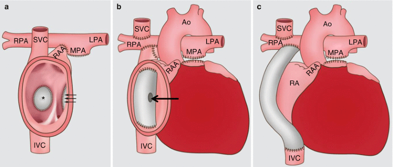 Systemic Vein to Pulmonary Artery Shunts: Glenn, Fontan, and Kawashima ...