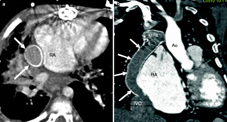 Systemic Vein to Pulmonary Artery Shunts: Glenn, Fontan, and Kawashima ...