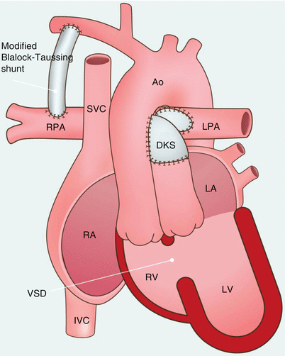 Damus–Kaye–Stansel Procedure | SpringerLink