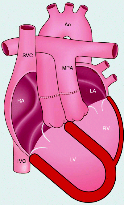 Double-Switch Procedure | SpringerLink