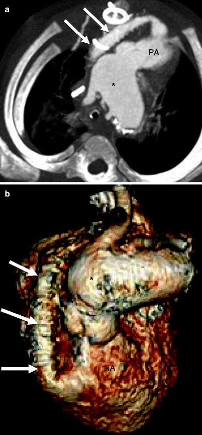 Norwood Procedures and Sano Modification | SpringerLink