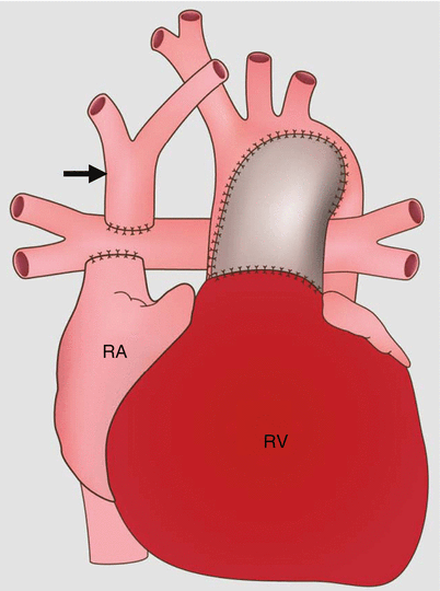 Norwood Procedures and Sano Modification | SpringerLink