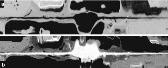Postmortem Computed Tomography (PMCT) Scanning with Angiography (PMCTA ...