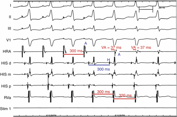How to Differentiate Between AVRT, AT, AVNRT, and Junctional ...