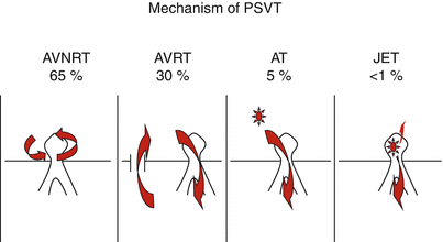 How to Differentiate Between AVRT, AT, AVNRT, and Junctional ...