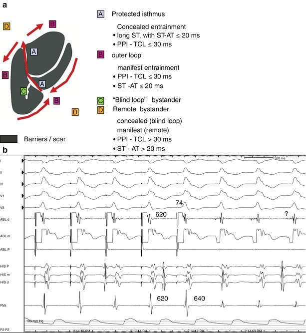 Programmed Stimulation During Mapping and Ablation of VT | SpringerLink