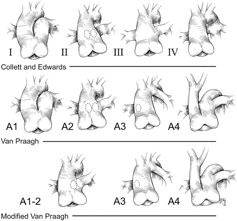 Truncus Arteriosus | SpringerLink