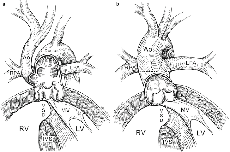 Truncus Arteriosus | SpringerLink