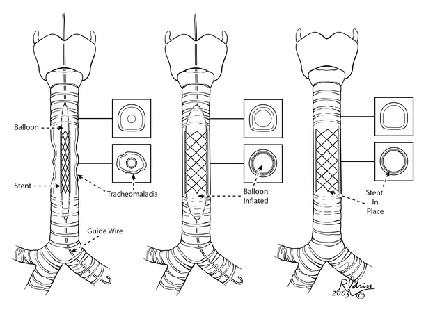 Vascular Rings, Tracheoplasty, and Pulmonary Artery Sling | SpringerLink