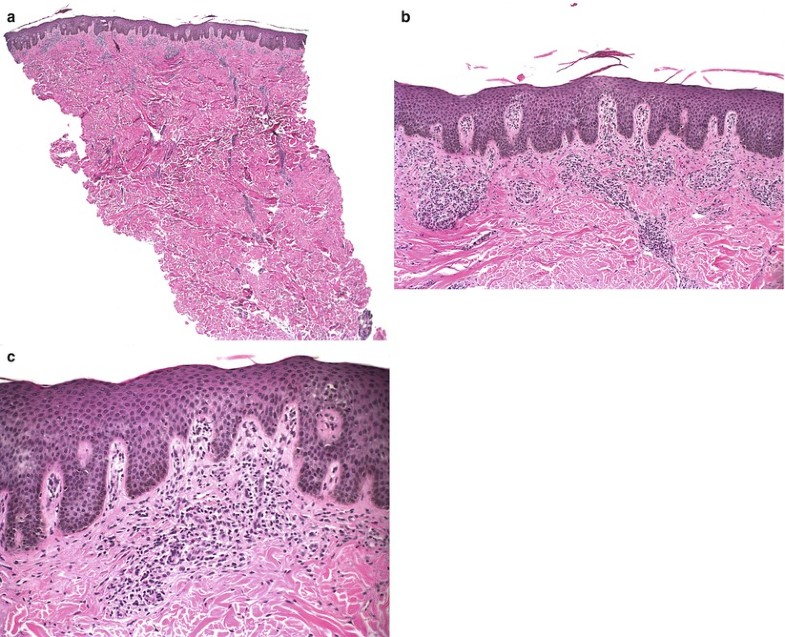 Drug Reaction Patterns | SpringerLink