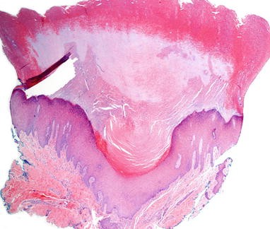 Epithelial Neoplasms | SpringerLink