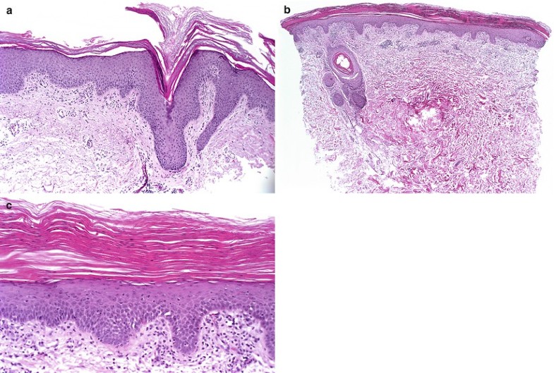 Psoriasiform Dermatoses | SpringerLink