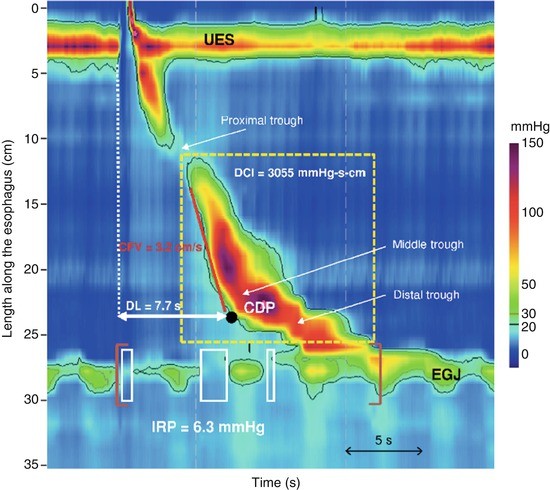 The Chicago Classification of Esophageal Motility Disorders | SpringerLink