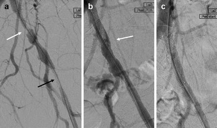 Flow-Limiting Iliac Artery Dissection Post-angioplasty | SpringerLink