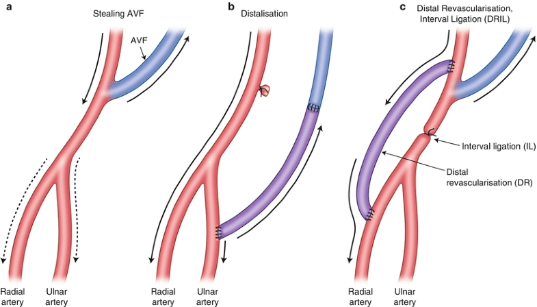 Vascular Access: Improving Outcomes for Haemodialysis Patients ...