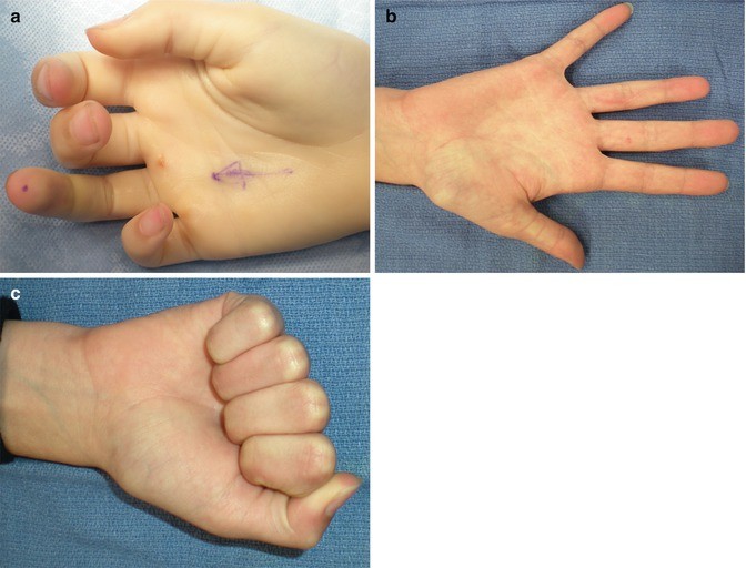 Hand Injuries in Children | SpringerLink