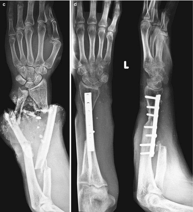 Massive Upper Limb Trauma | SpringerLink