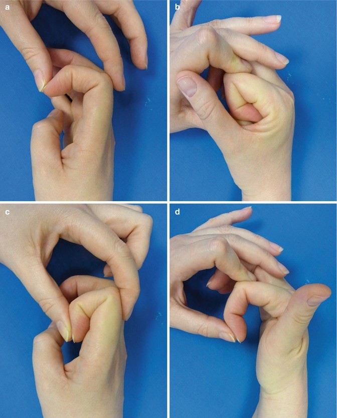 Post-Traumatic Contracture | SpringerLink