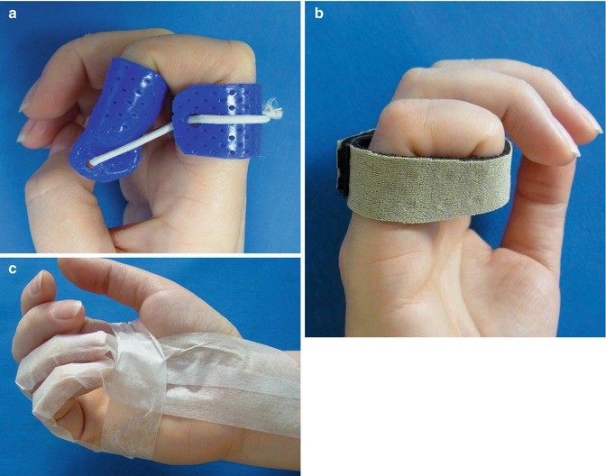 Post-Traumatic Contracture | SpringerLink