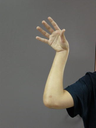 Neurological Contractures: The Spastic Upper Limb | SpringerLink