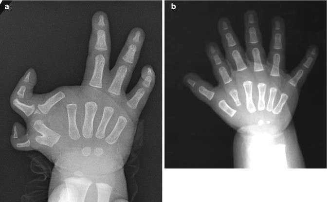 Polydactyly | SpringerLink