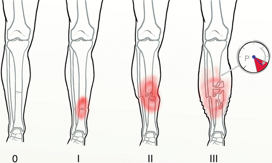 Soft Tissue Injuries | SpringerLink