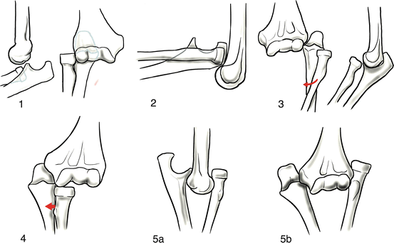 Elbow Dislocation | SpringerLink