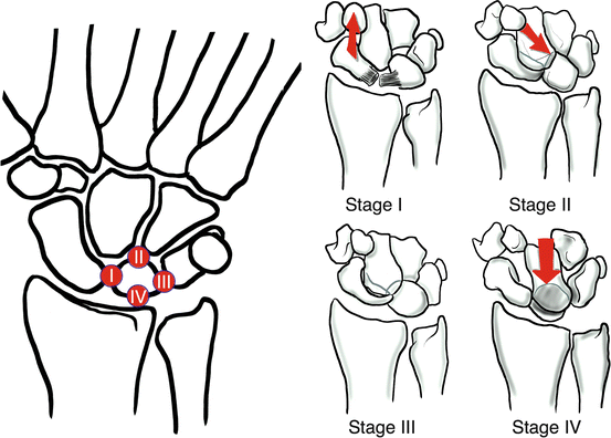 Lesser Arc Injuries: Perilunate Dislocations | SpringerLink