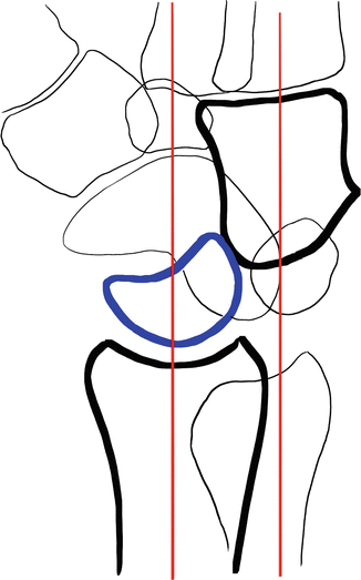 Lesser Arc Injuries: Perilunate Dislocations | SpringerLink