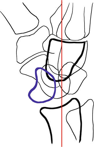 Lesser Arc Injuries: Perilunate Dislocations | SpringerLink