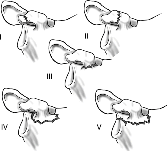 Coracoid Fractures | SpringerLink